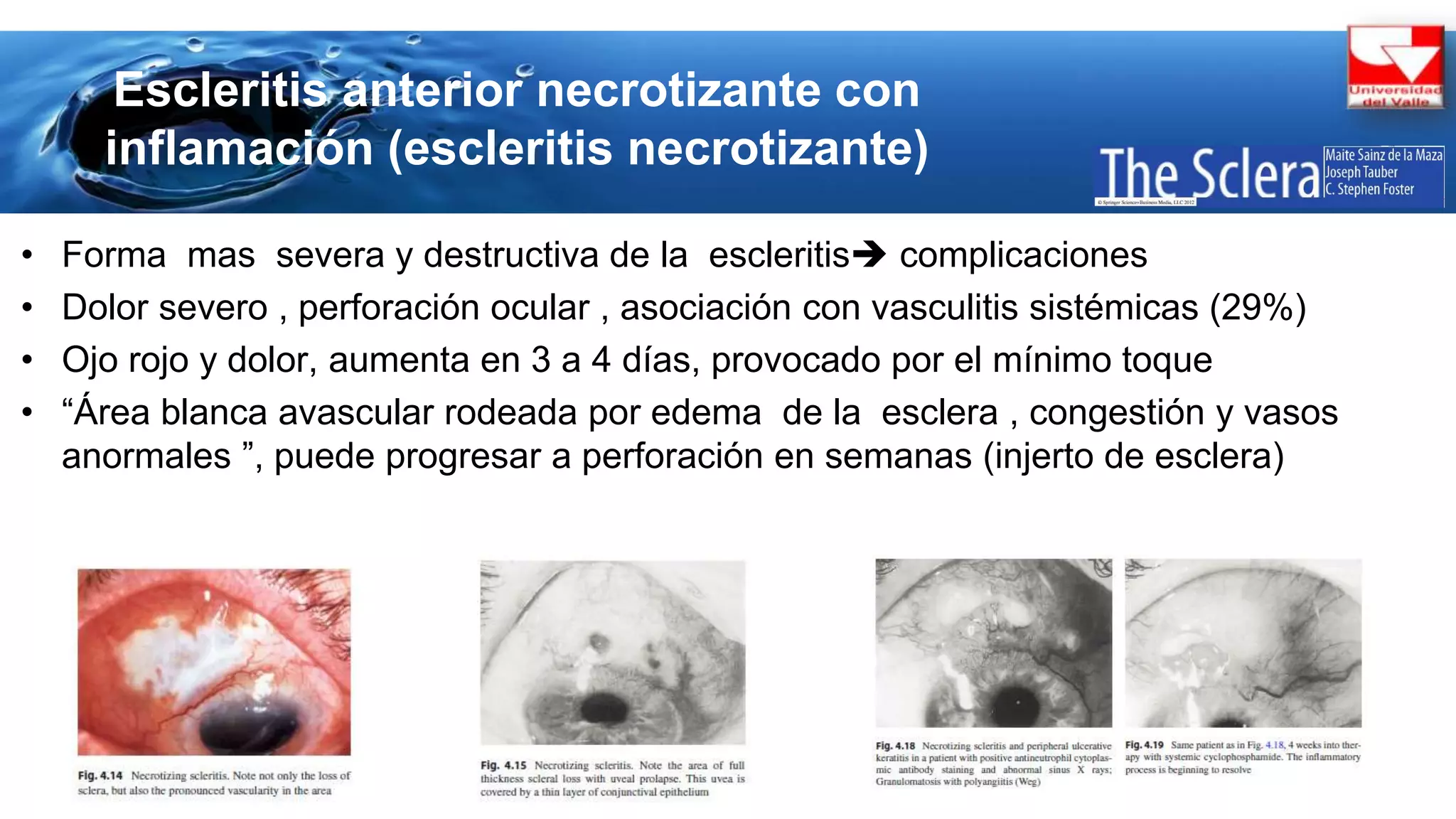 Epiescleritis y escleritis en oftalmologia