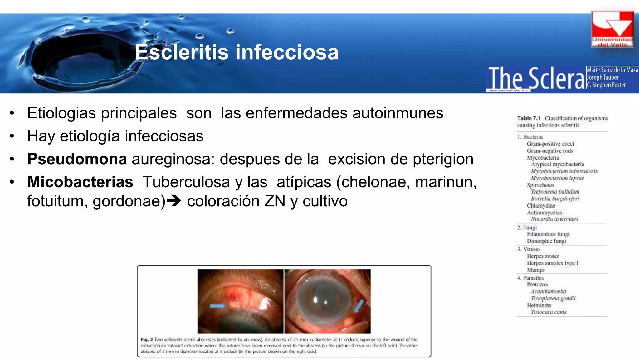 Epiescleritis y escleritis en oftalmologia