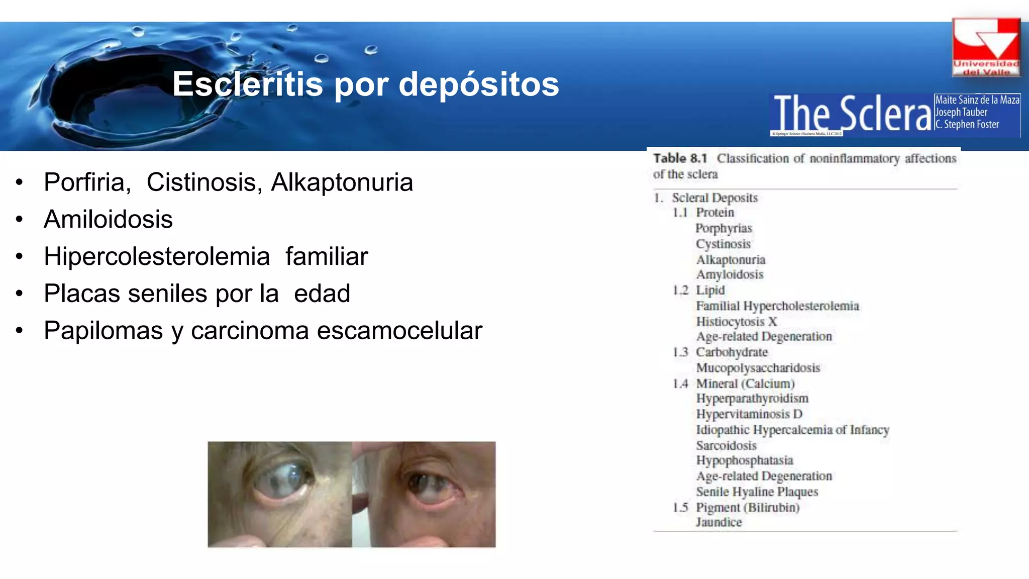 Epiescleritis y escleritis en oftalmologia