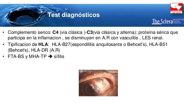 Epiescleritis y escleritis en oftalmologia