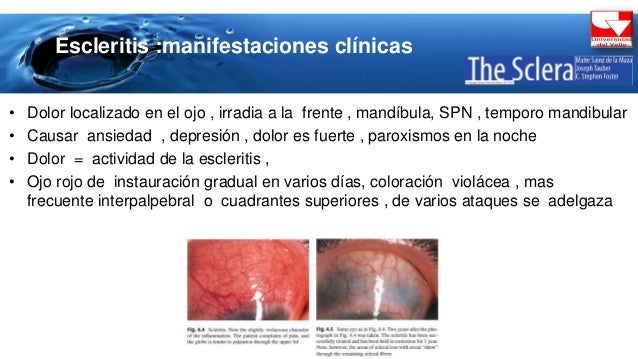 Epiescleritis y escleritis en oftalmologia