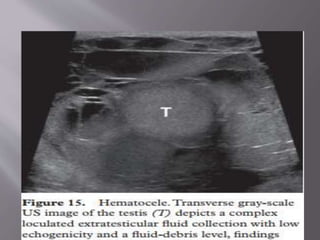 Hematocele Ultrasound