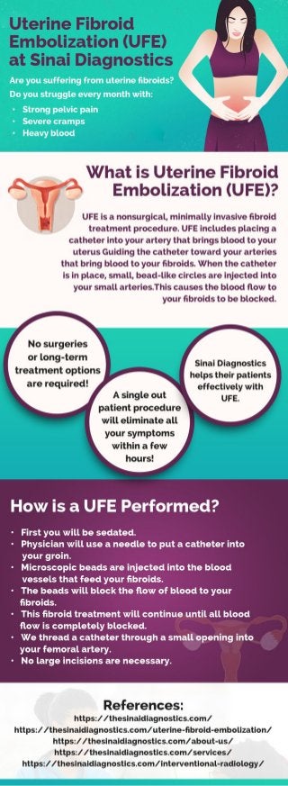 Uterine Fibroid Embolization (UFE) at Sinai Diagnostics