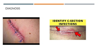 Surgical site wound infection and it's manifestation | PPTX