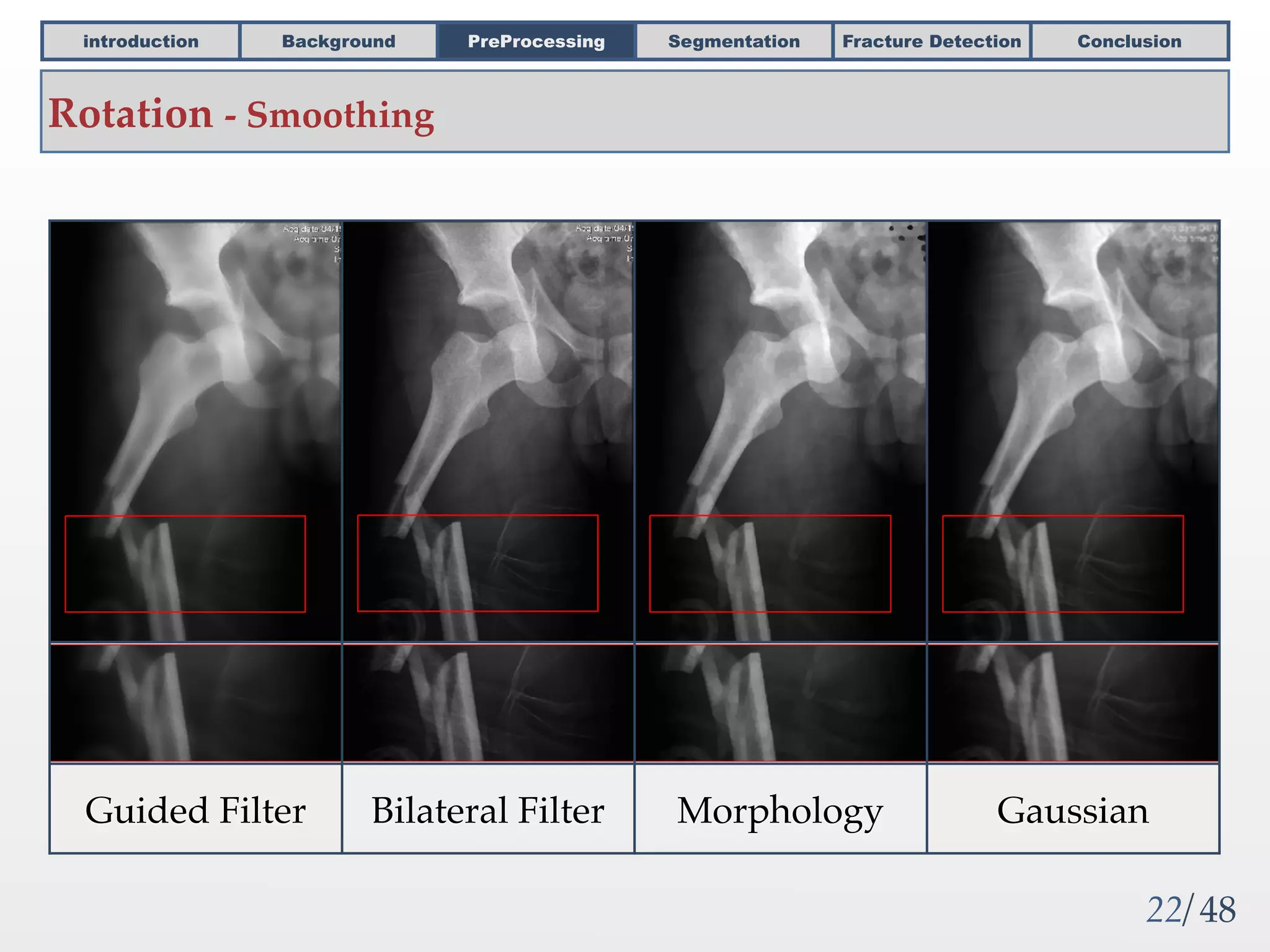 Master thesis - Long Bone Segmentation and Fracture Detection in X-ray Images | PDF