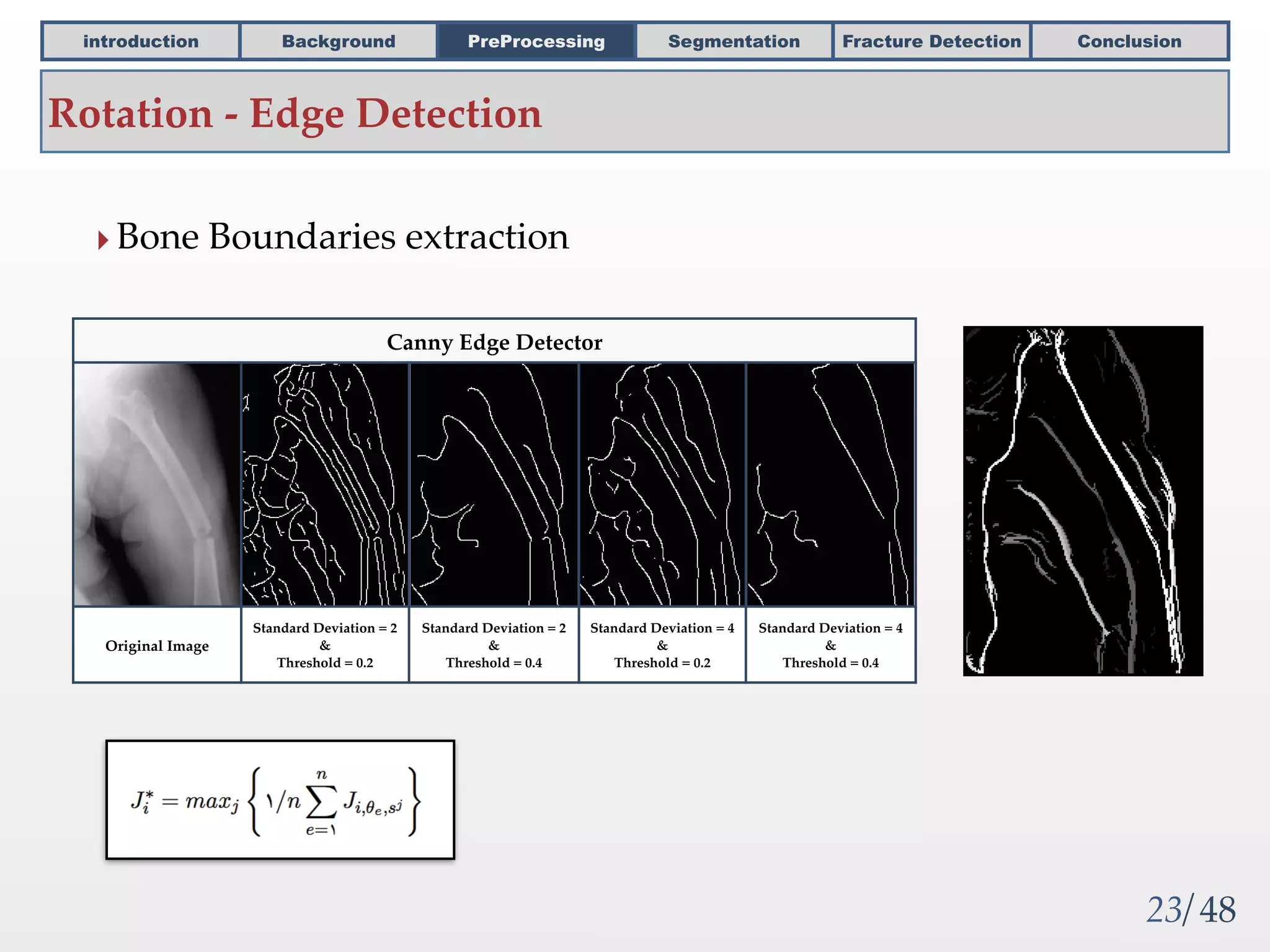 Master thesis - Long Bone Segmentation and Fracture Detection in X-ray ...