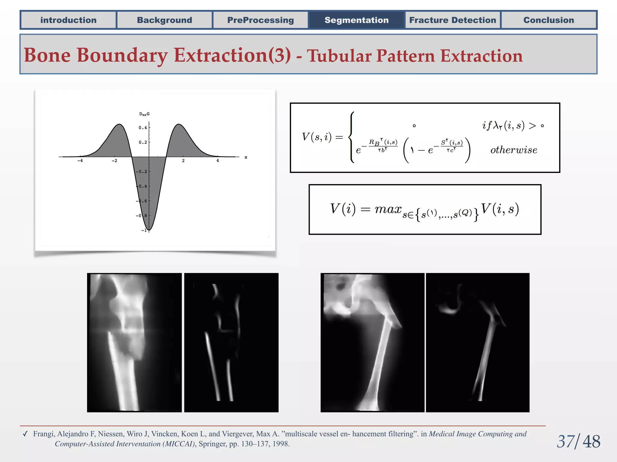 Master thesis - Long Bone Segmentation and Fracture Detection in X-ray Images | PDF
