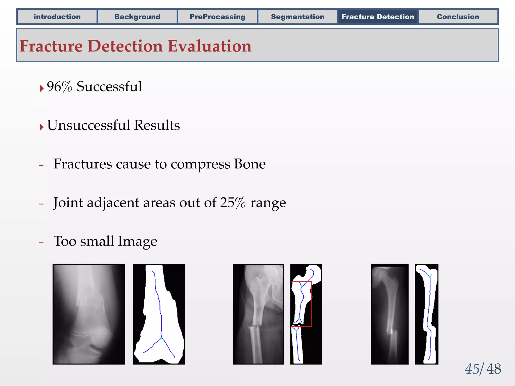 Master thesis - Long Bone Segmentation and Fracture Detection in X-ray Images | PDF
