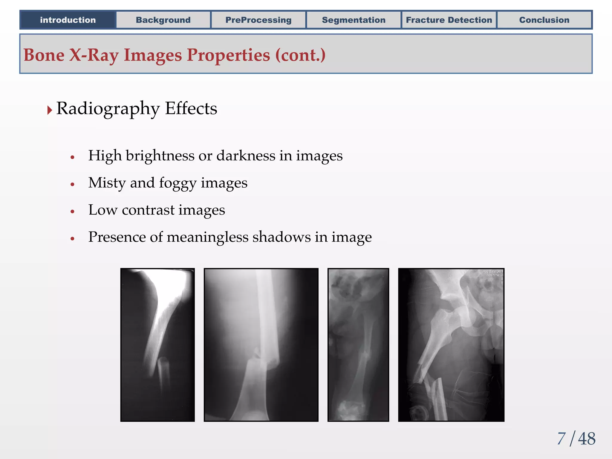 Master Thesis Long Bone Segmentation And Fracture Detection In X Ray