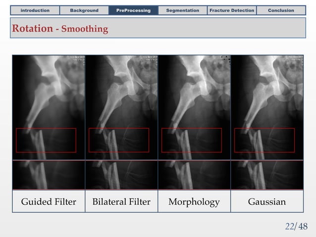 Master thesis - Long Bone Segmentation and Fracture Detection in X-ray Images | PDF