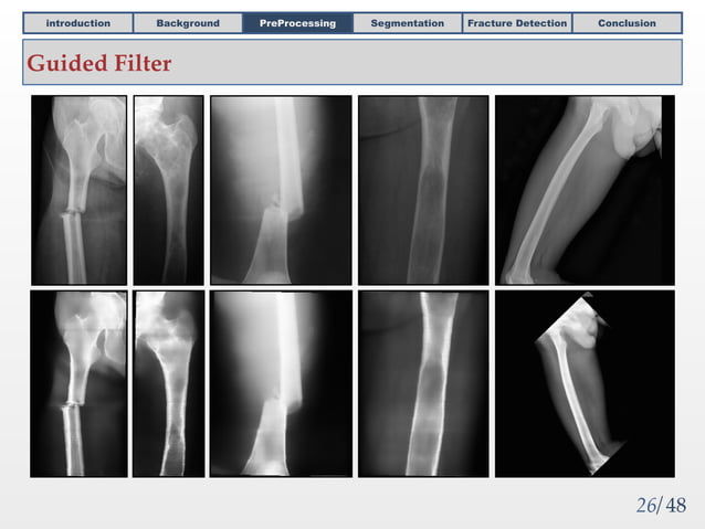 Master Thesis Long Bone Segmentation And Fracture Detection In X Ray