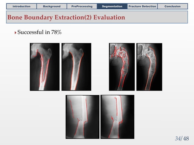 Master Thesis Long Bone Segmentation And Fracture Detection In X Ray