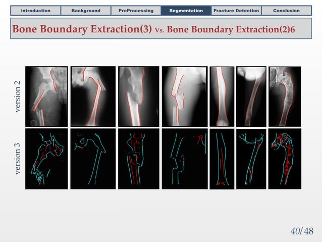 Master Thesis Long Bone Segmentation And Fracture Detection In X Ray