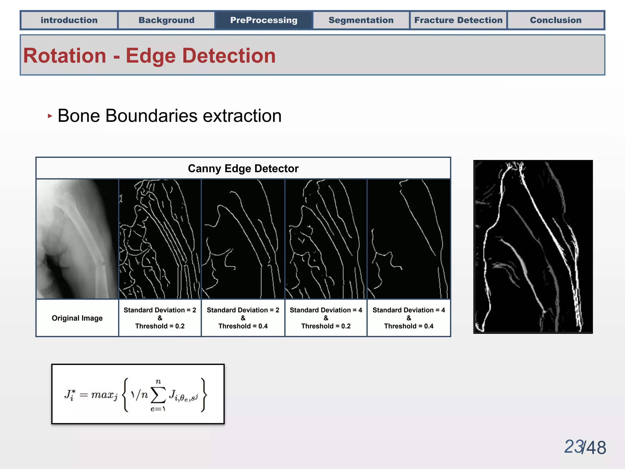 Master thesis - Long Bone Segmentation and Fracture Detection in X-ray ...