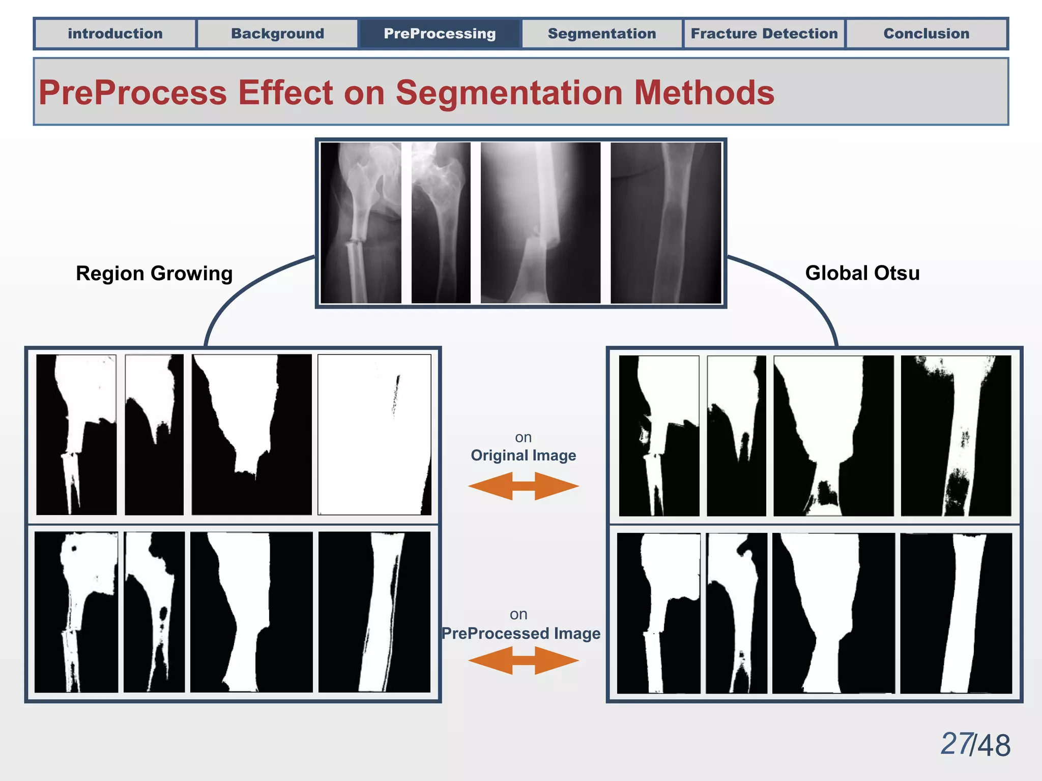 Master thesis - Long Bone Segmentation and Fracture Detection in X-ray ...