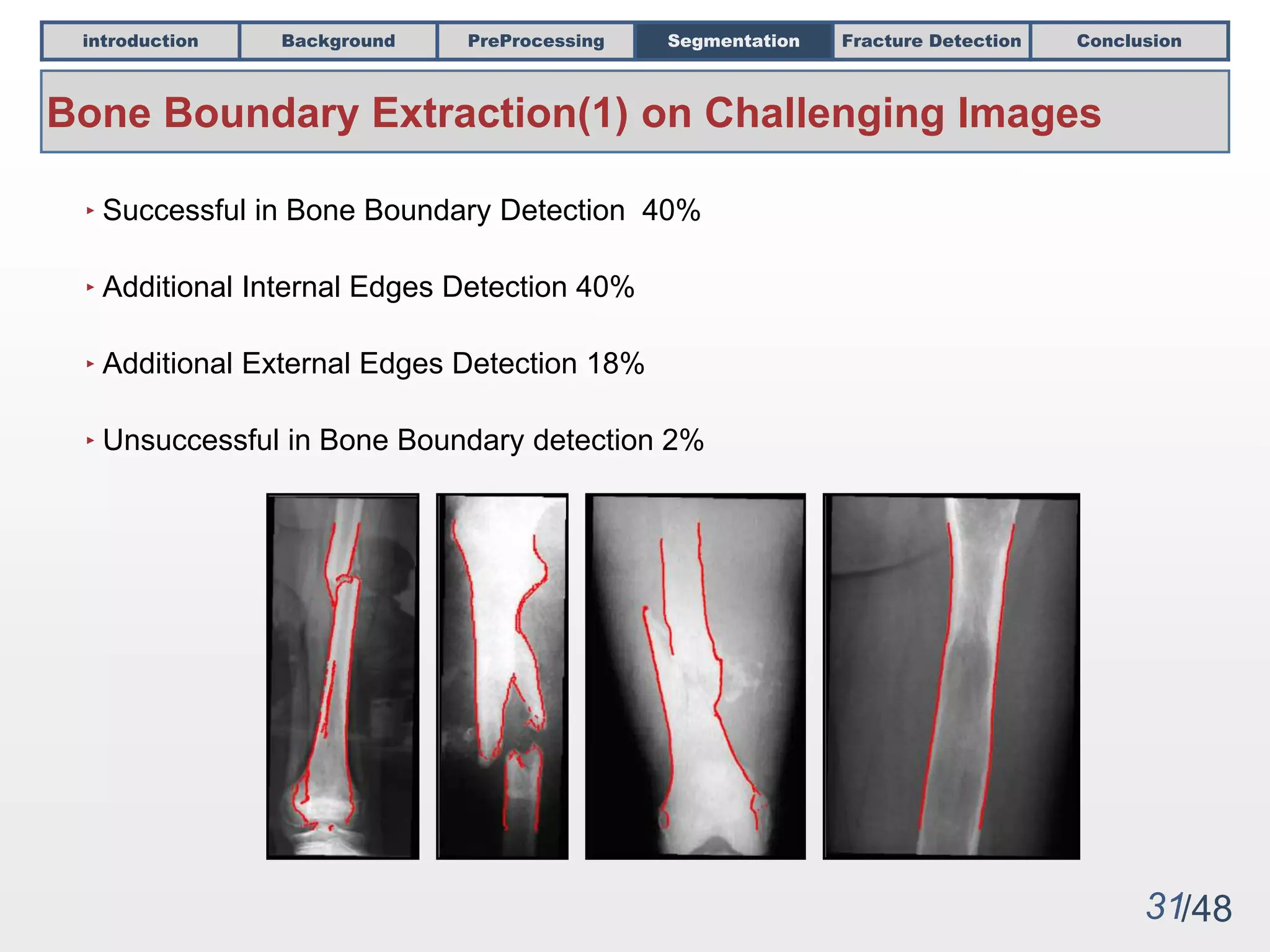 Master thesis - Long Bone Segmentation and Fracture Detection in X-ray ...