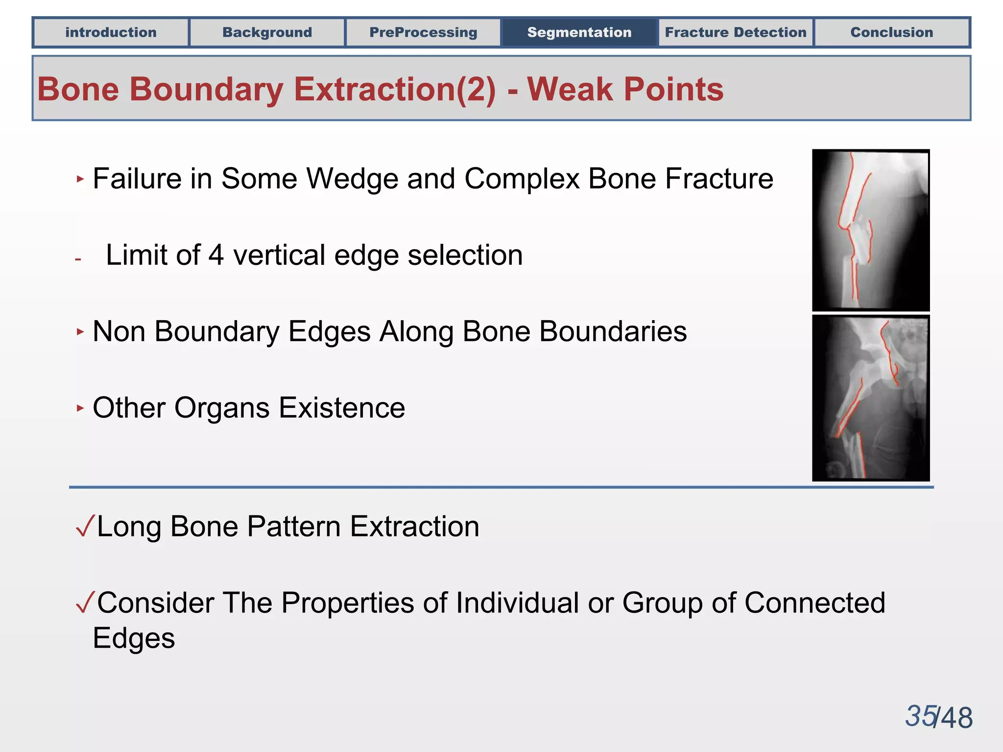 Master thesis - Long Bone Segmentation and Fracture Detection in X-ray ...