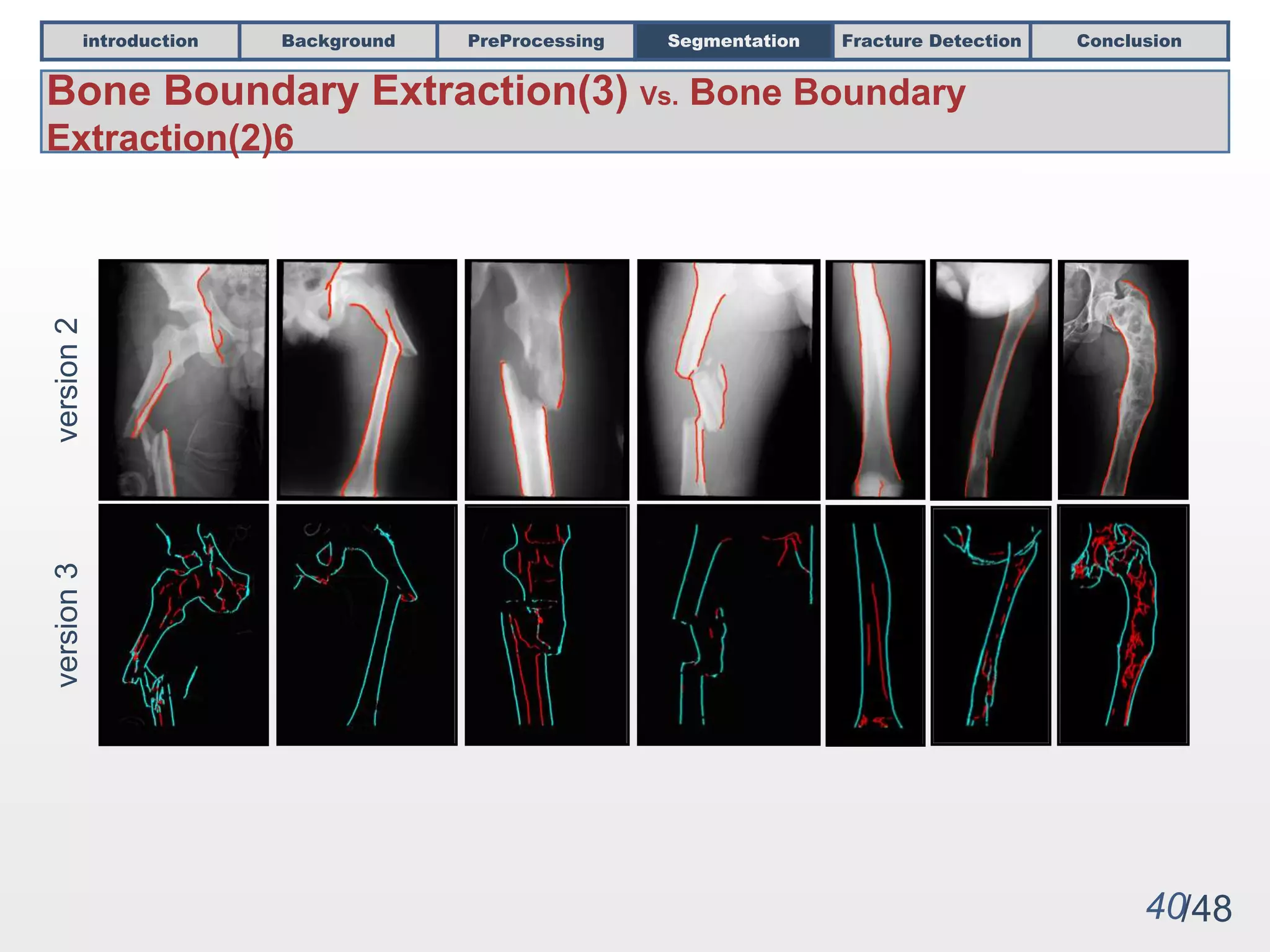 Master thesis - Long Bone Segmentation and Fracture Detection in X-ray ...
