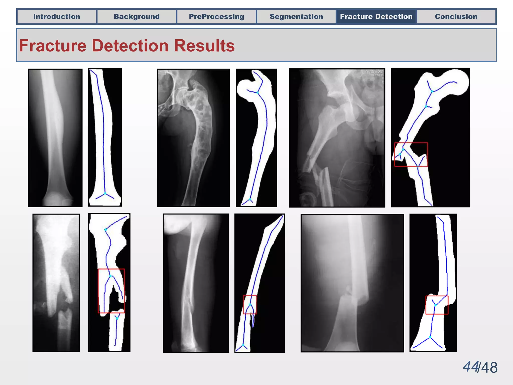 Master thesis - Long Bone Segmentation and Fracture Detection in X-ray Images | PPT