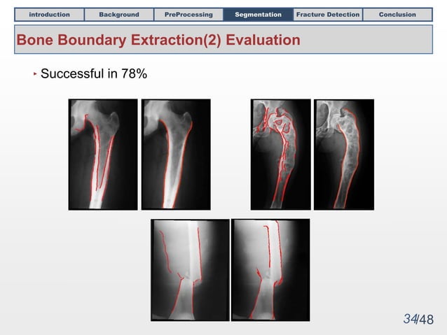 Master thesis - Long Bone Segmentation and Fracture Detection in X-ray ...