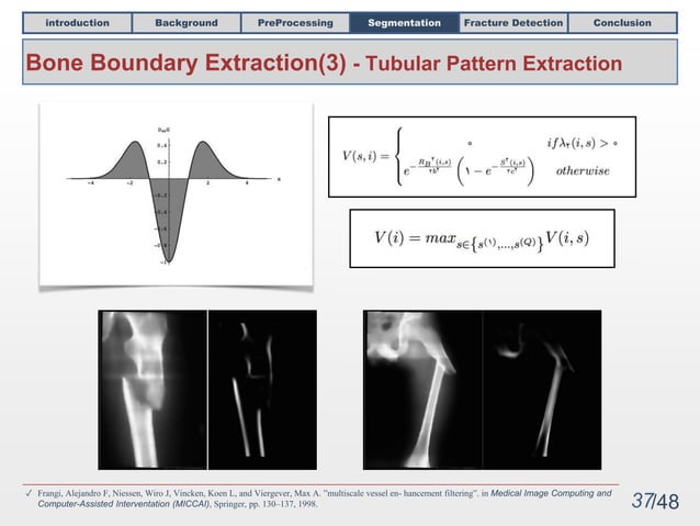 Master Thesis Long Bone Segmentation And Fracture Detection In X Ray
