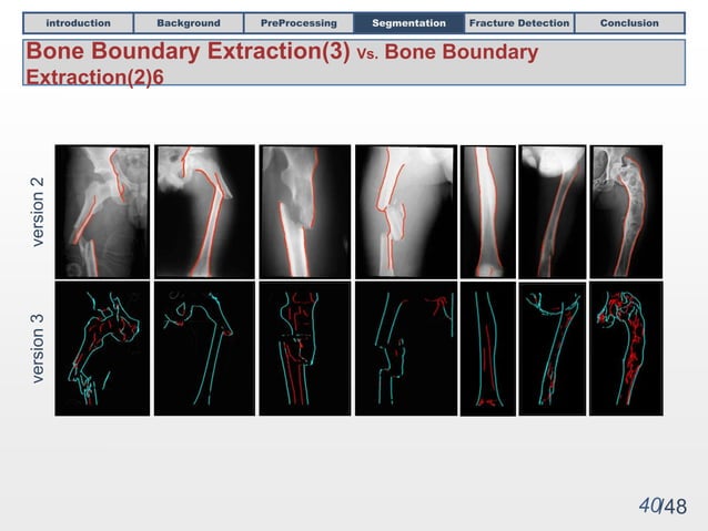 Master Thesis Long Bone Segmentation And Fracture Detection In X Ray