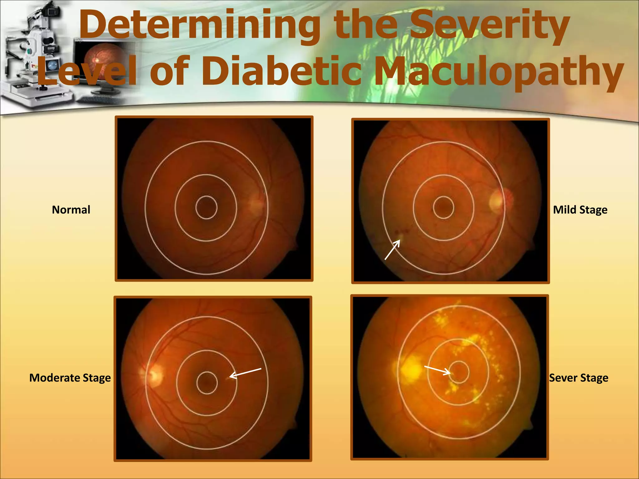 Automatic Detection of Diabetic Maculopathy from Fundus Images Using Image Analysis Techniques | PPT