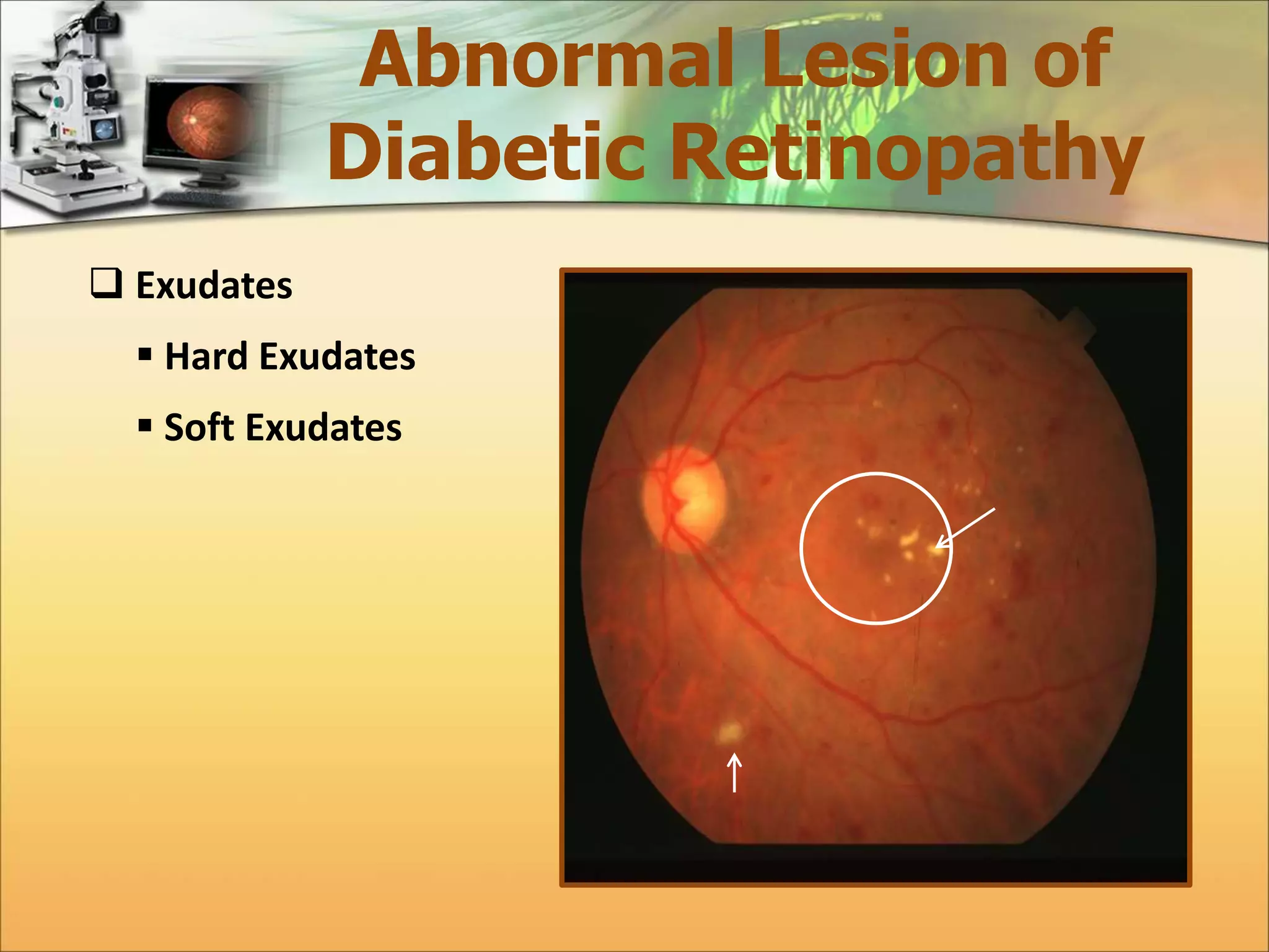 Automatic Detection of Diabetic Maculopathy from Fundus Images Using Image Analysis Techniques | PPT