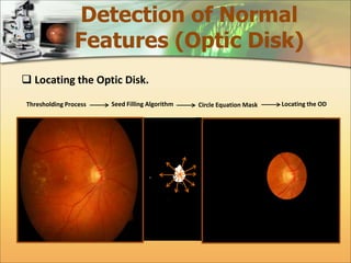 Automatic Detection of Diabetic Maculopathy from Fundus Images Using ...
