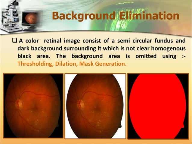 Automatic Detection of Diabetic Maculopathy from Fundus Images Using Image Analysis Techniques