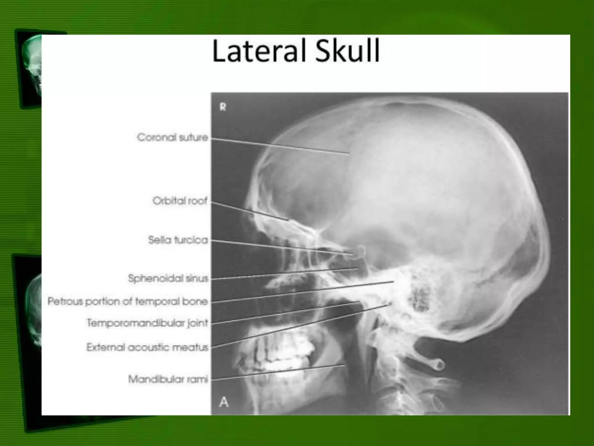 SKULL: Radiologic Positioning (Non-contrast) | PPTX