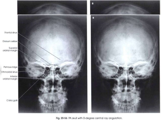 SKULL: Radiologic Positioning (Non-contrast) | PPTX