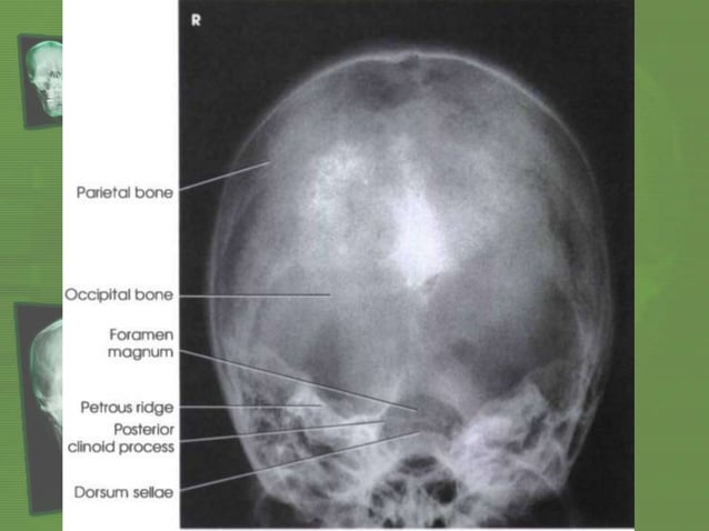 SKULL: Radiologic Positioning (Non-contrast) | PPTX