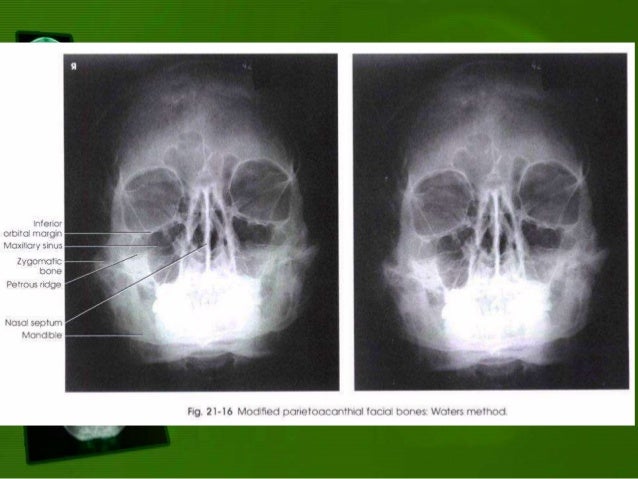 SKULL: Radiologic Positioning (Non-contrast)