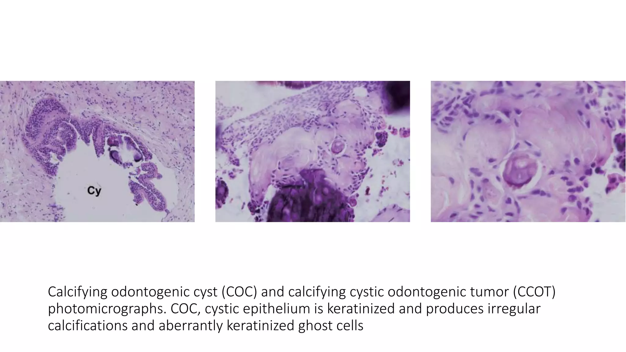 The so called Calcifying Odontogenic Cyst (Doctor Faris Alabeedi MSc ...