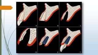 The socket shield technique at molar sites | PPTX