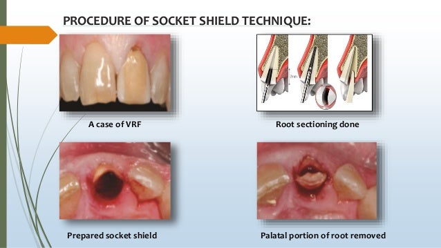 The socket shield technique at molar sites