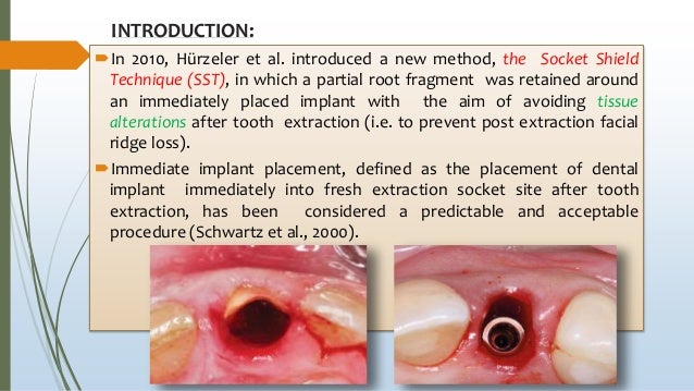 The socket shield technique at molar sites