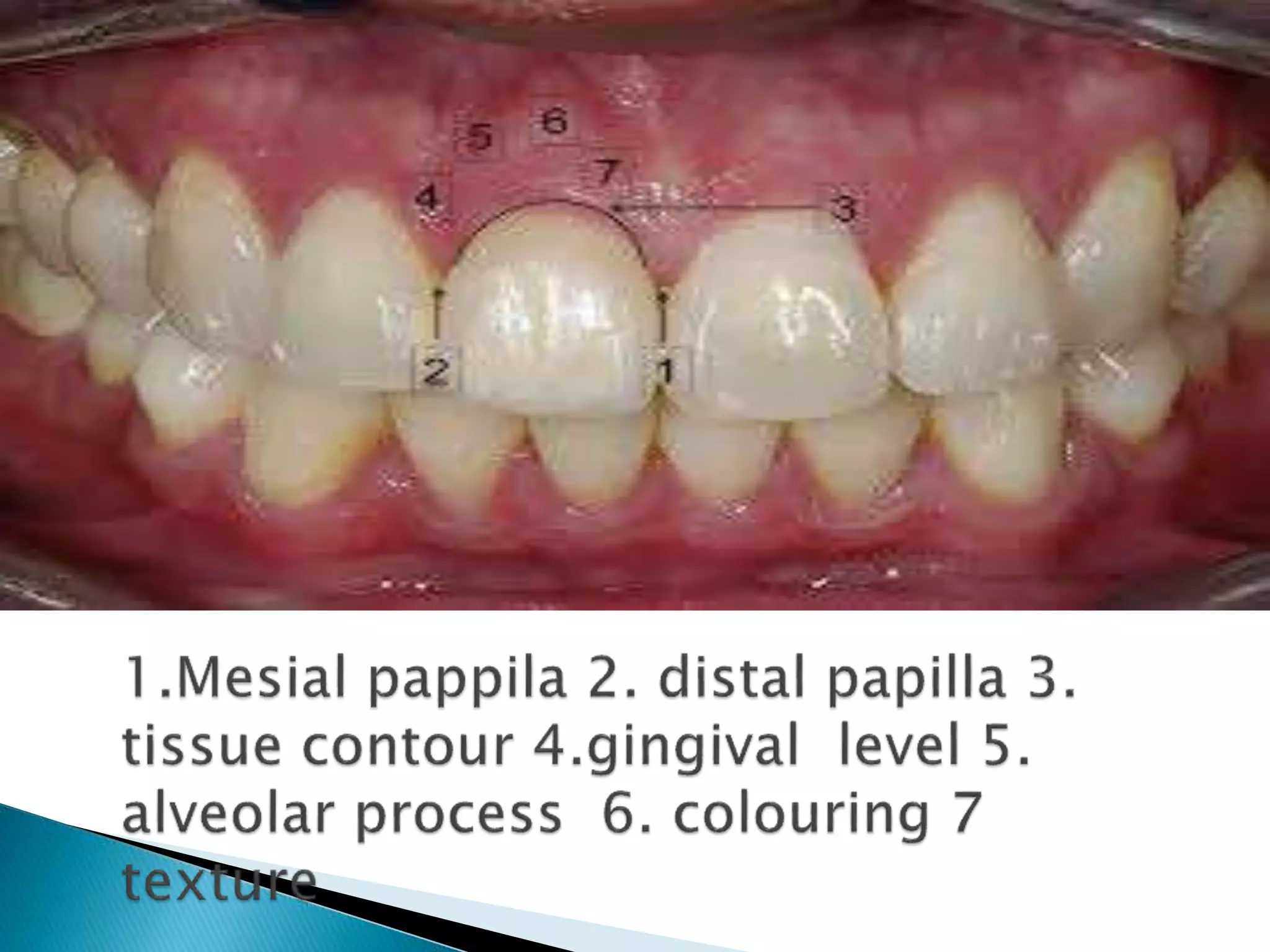 The socket-shield technique (SST).pptx