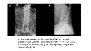 THE SPINE IN THE COURSE OF SPONDYLOARTHROPATHIES.pptx