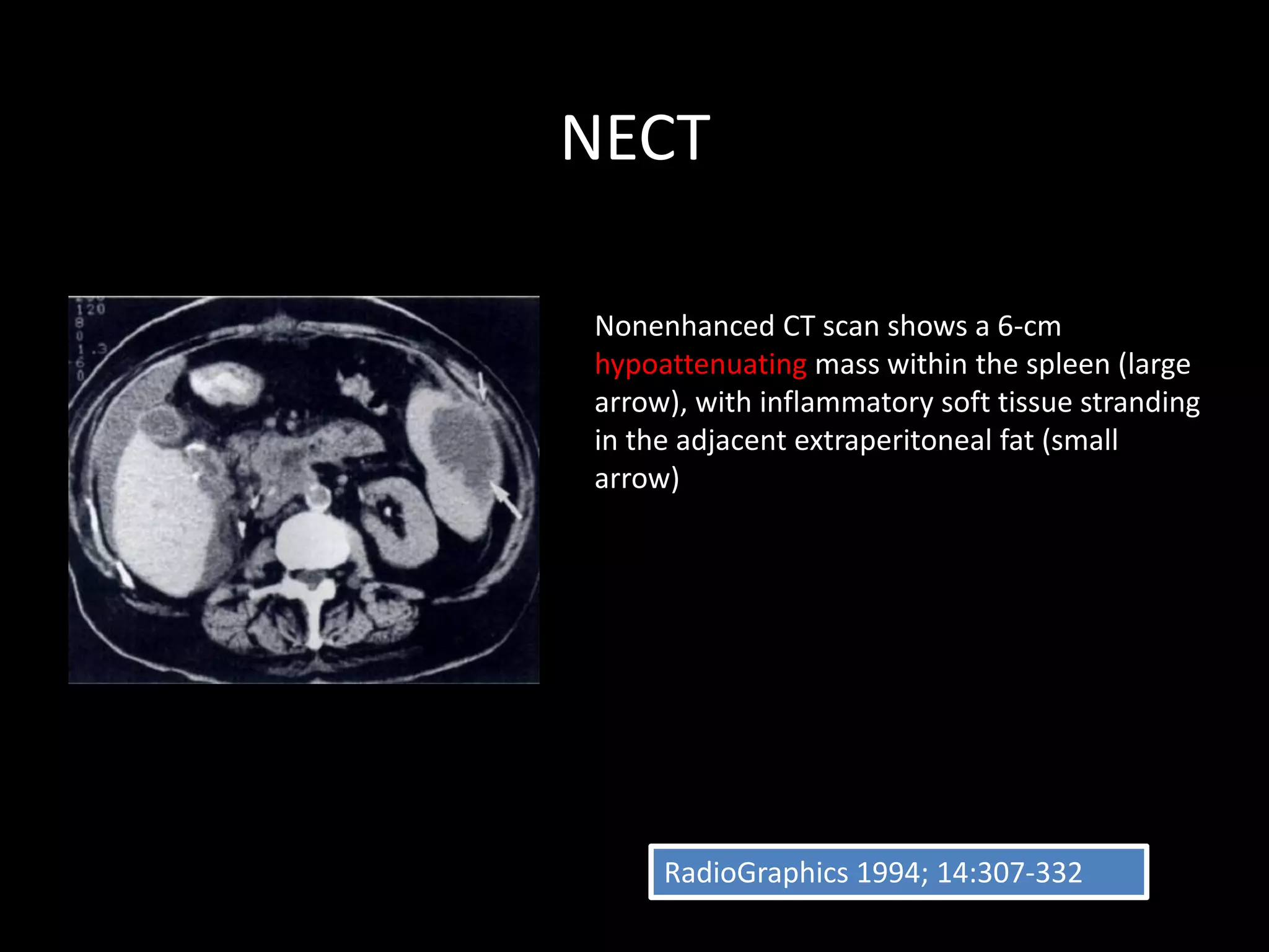 The spleen in surgery in general | PPTX
