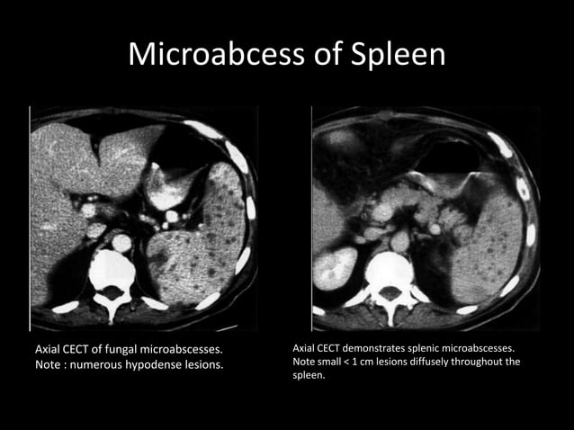 The spleen in surgery in general | PPTX