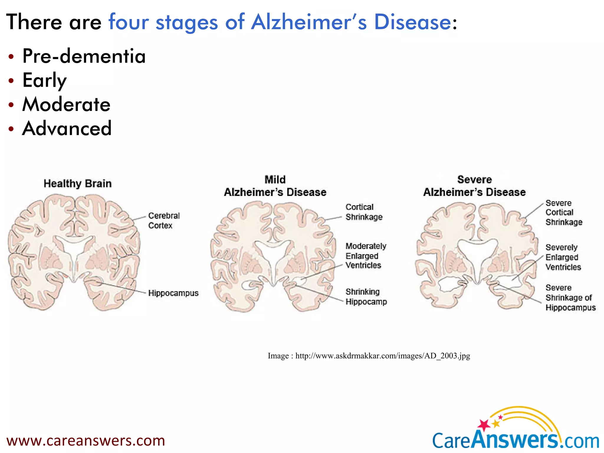 The Stages of Alzheimer’s Disease | PPT