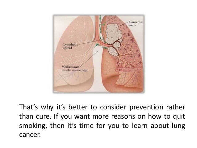 The Stages of Lung Cancer Caused by Smoking