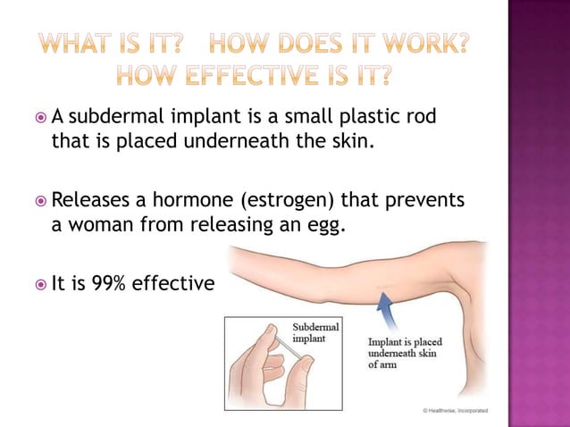 The Subdermal Implant Health | PPTX