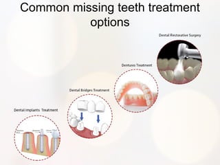 The Successful Tooth Replacement Options for Missing Teeth | PPT
