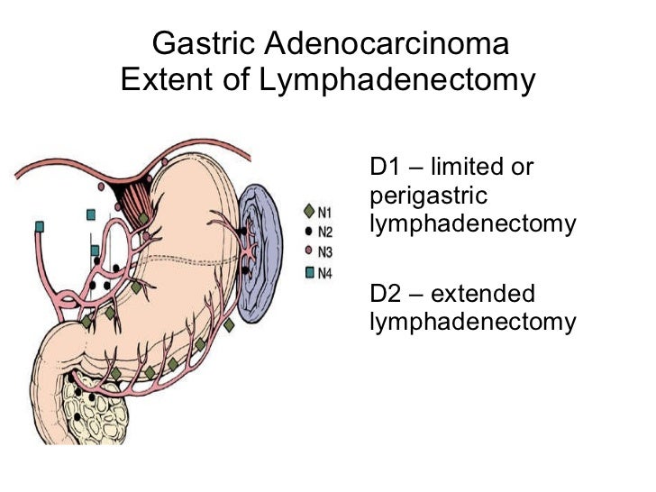 The Surgical Management Of Gastroesophageal Cancer
