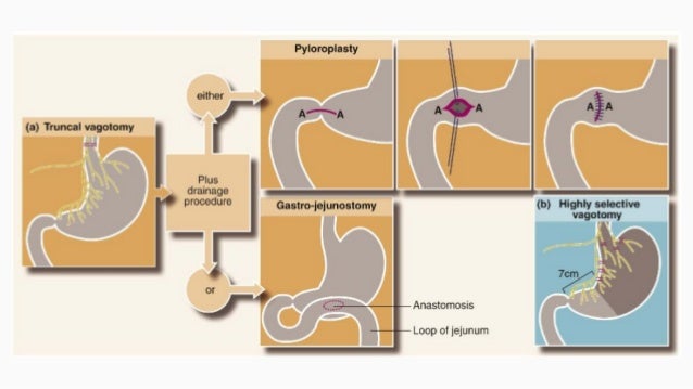 The surgical management of the gastric ulcers and the tumors of the s…