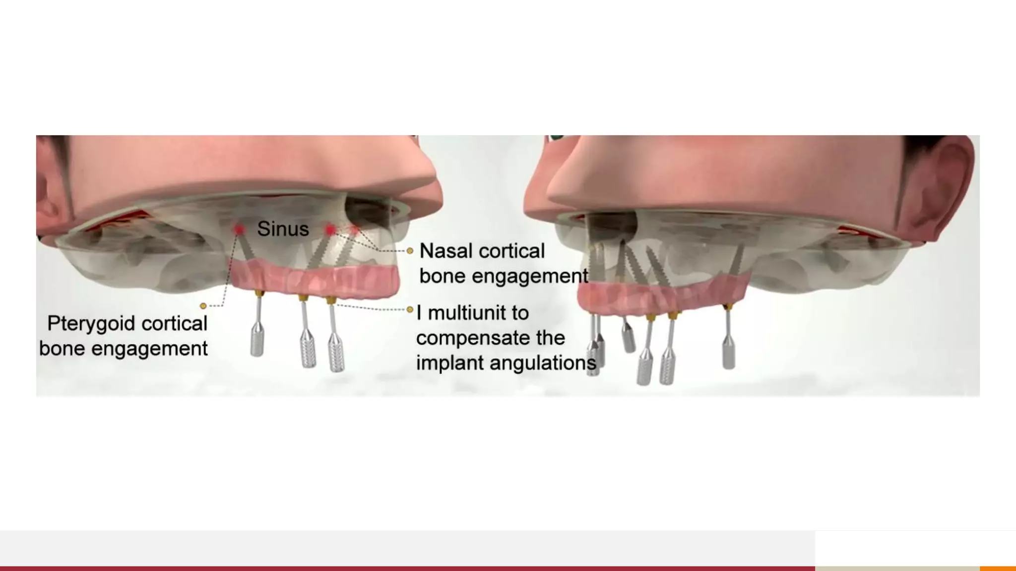 The Tall Tilted Pin Hole Placement Immediate Loading.pptx