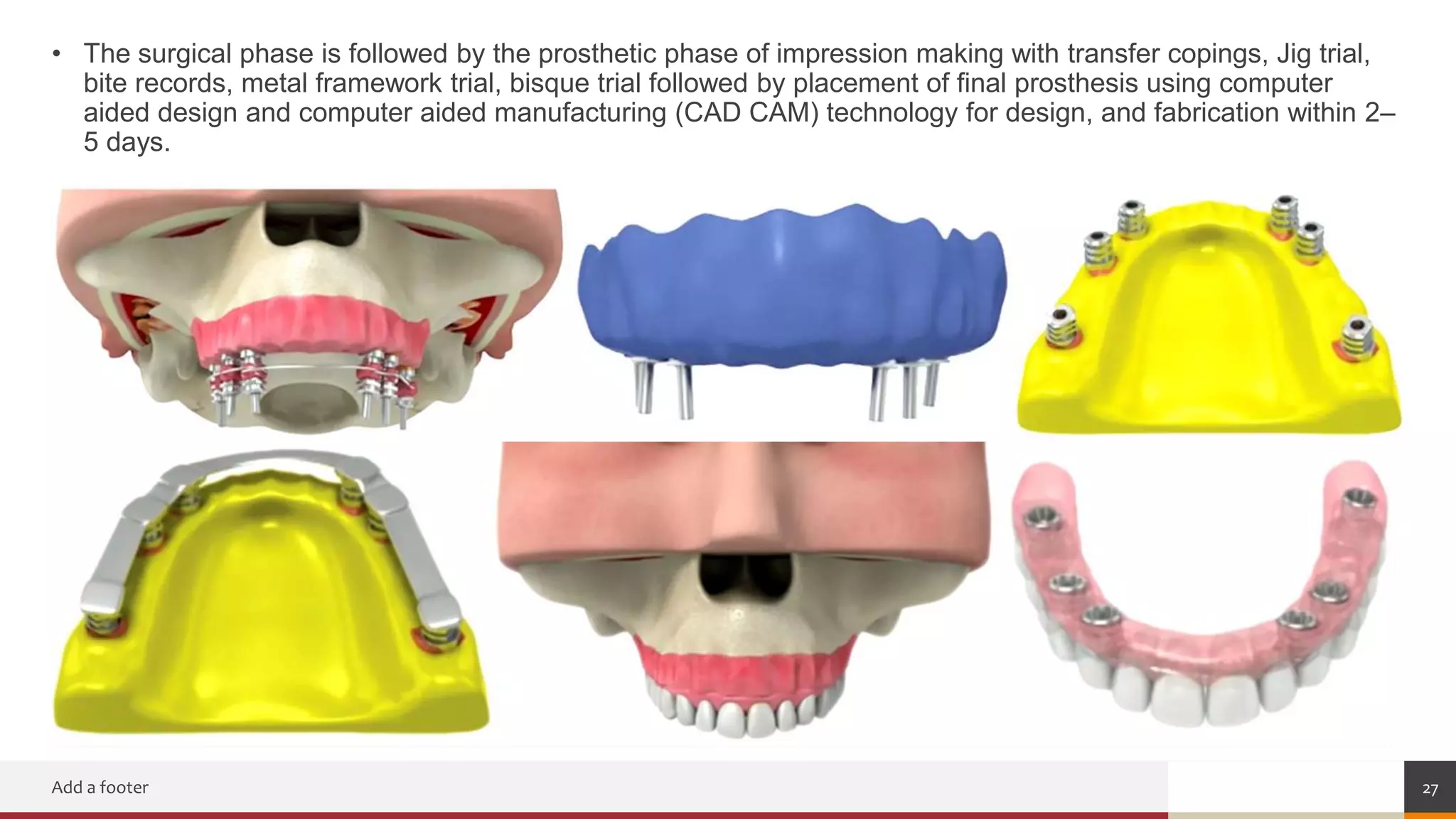 The Tall Tilted Pin Hole Placement Immediate Loading.pptx